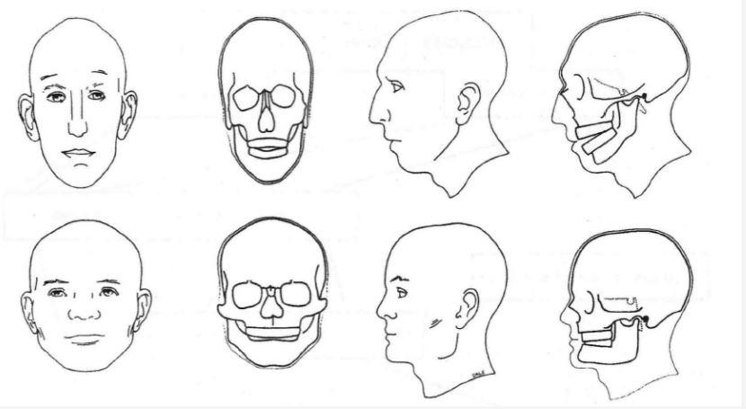 The maxilla is what determines your attractiveness and not your jaw ...