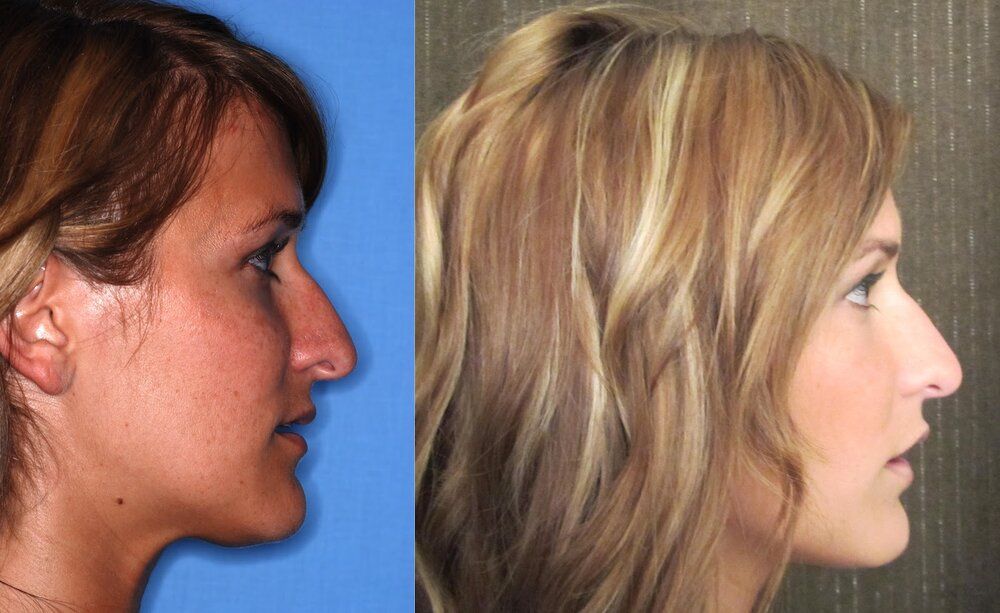 this is how a lefort 2 result looks like | Looksmax.org - Men's Self ...