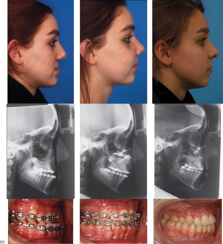 High "Quadrangular" Lefort 1 + IMM Implants = Lefort 3 MEGATHREAD ...