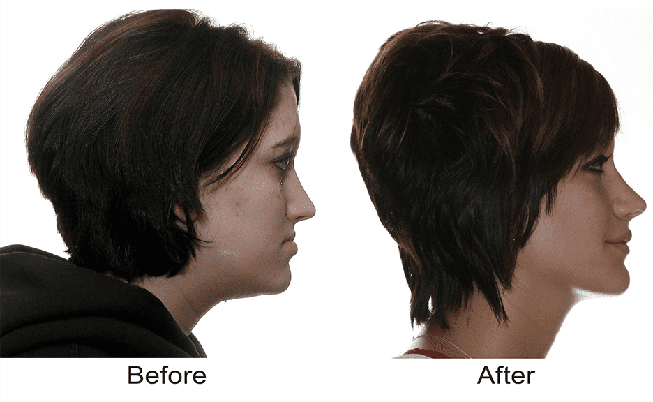 What Is forward maxilla | Looksmax.org - Men's Self-Improvement ...