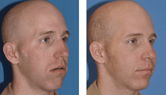 Do NOT get Submalar Implants | Looksmax.org - Men's Self-Improvement ...