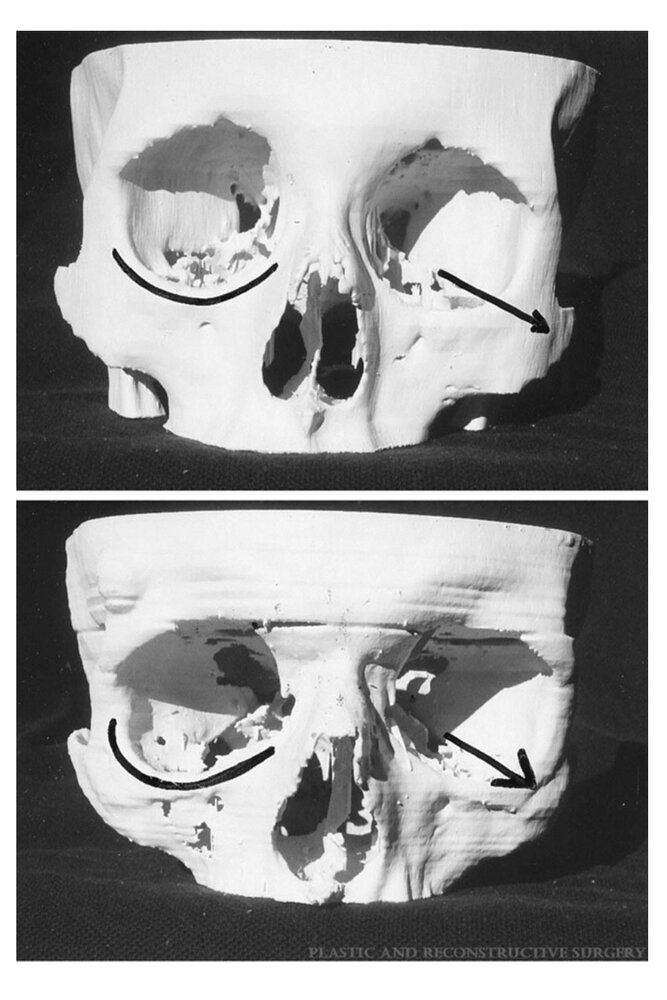 Loss of bone mass on face with age | Looksmax.org - Men's Self ...
