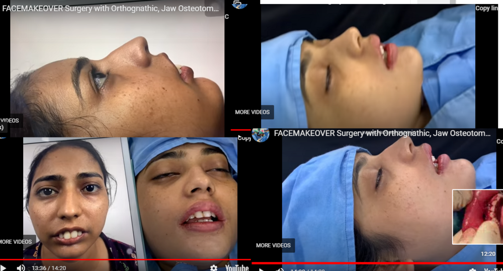 This Bimax and Genio results | Looksmax.org - Men's Self-Improvement ...