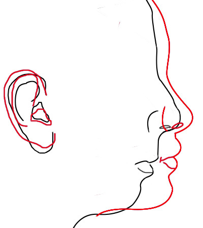 Does cutting maxilla vertically rotate jaw CCW wise? | Looksmax - Men's ...