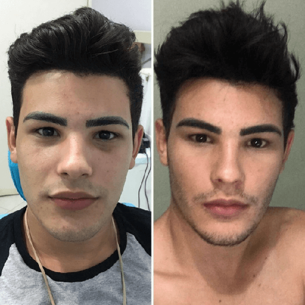 Buccal fat removal UNDERRATED surgery | Looksmax.org - Men's Self ...