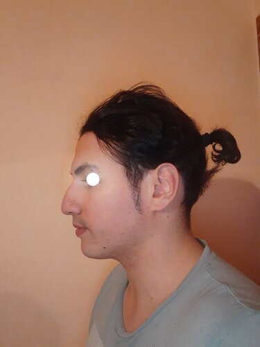 Can a septoplasty alone is enough to slighlty improve the nose ...