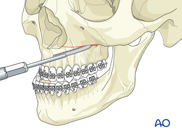 What does extracting the top premolars for jaw surgery allow the ...