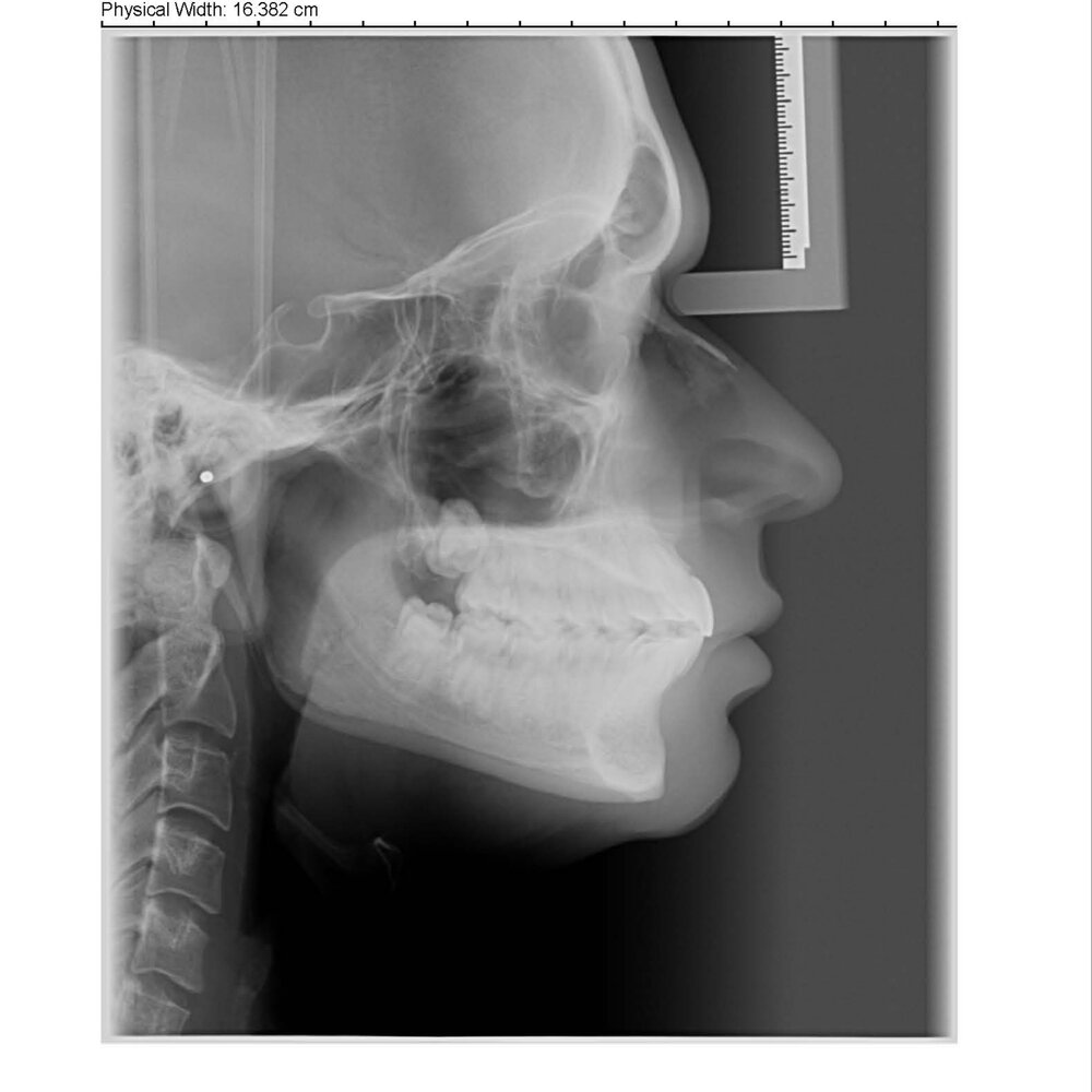 What does extracting the top premolars for jaw surgery allow the ...