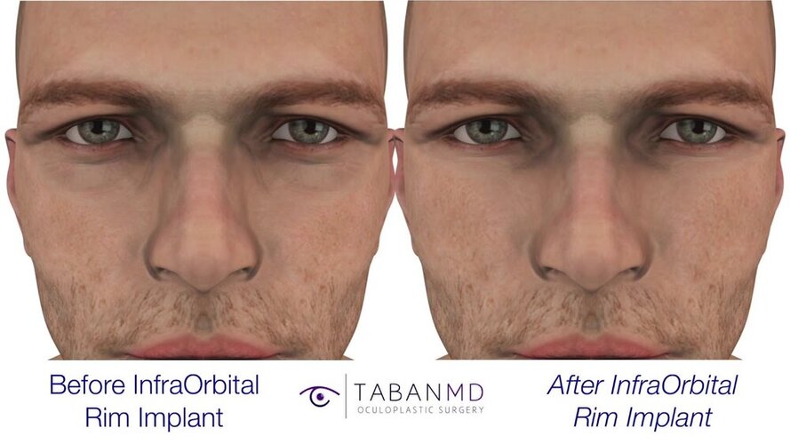 Infraorbital rims implants or fillers for under eyes support ...