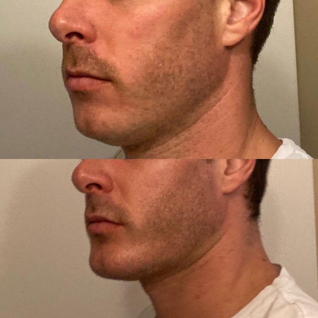 Why do Chin Implants look so bad? | Looksmax.org - Men's Self ...
