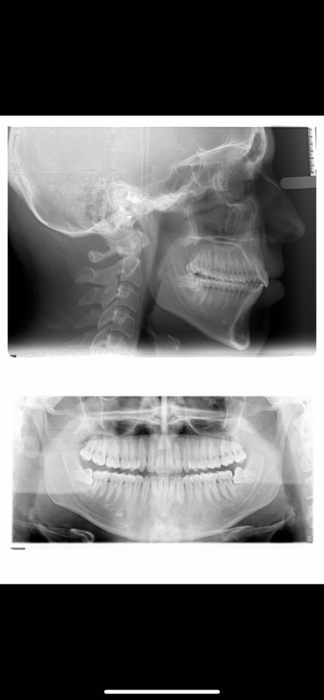 Is my maxilla too long? | Looksmax - Men's Self-Improvement & Aesthetics