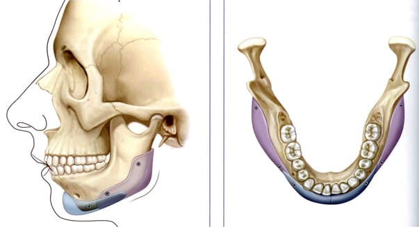 Wrap around jaw implants or chin and jaw implants | Looksmax - Men's ...