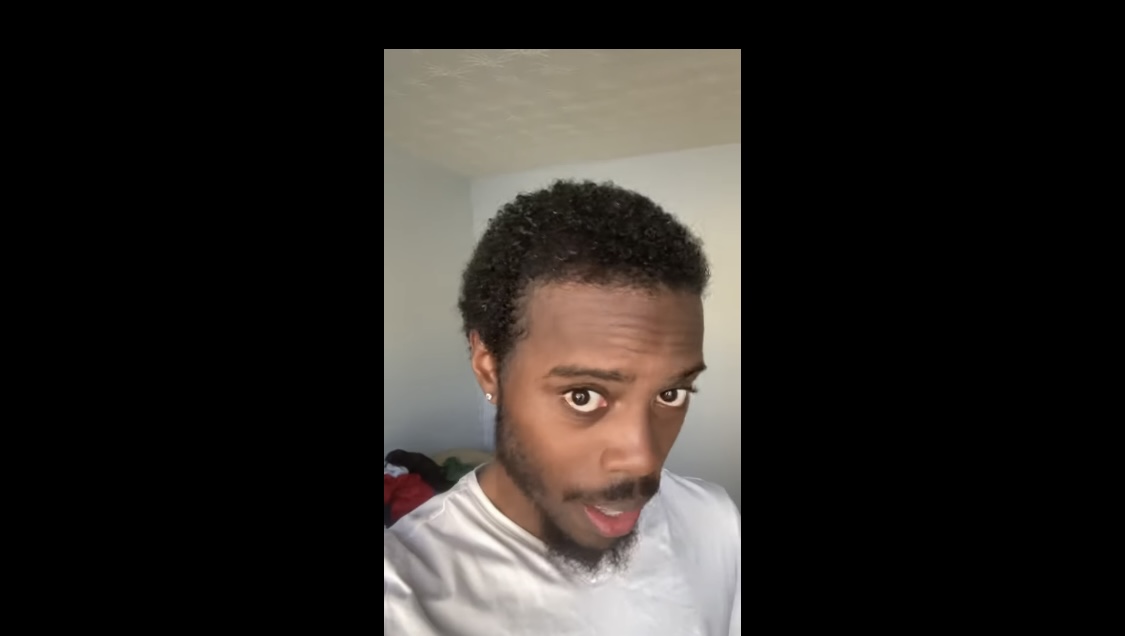 Why do hair transplant customers never get a NW0 hairline? | Looksmax ...