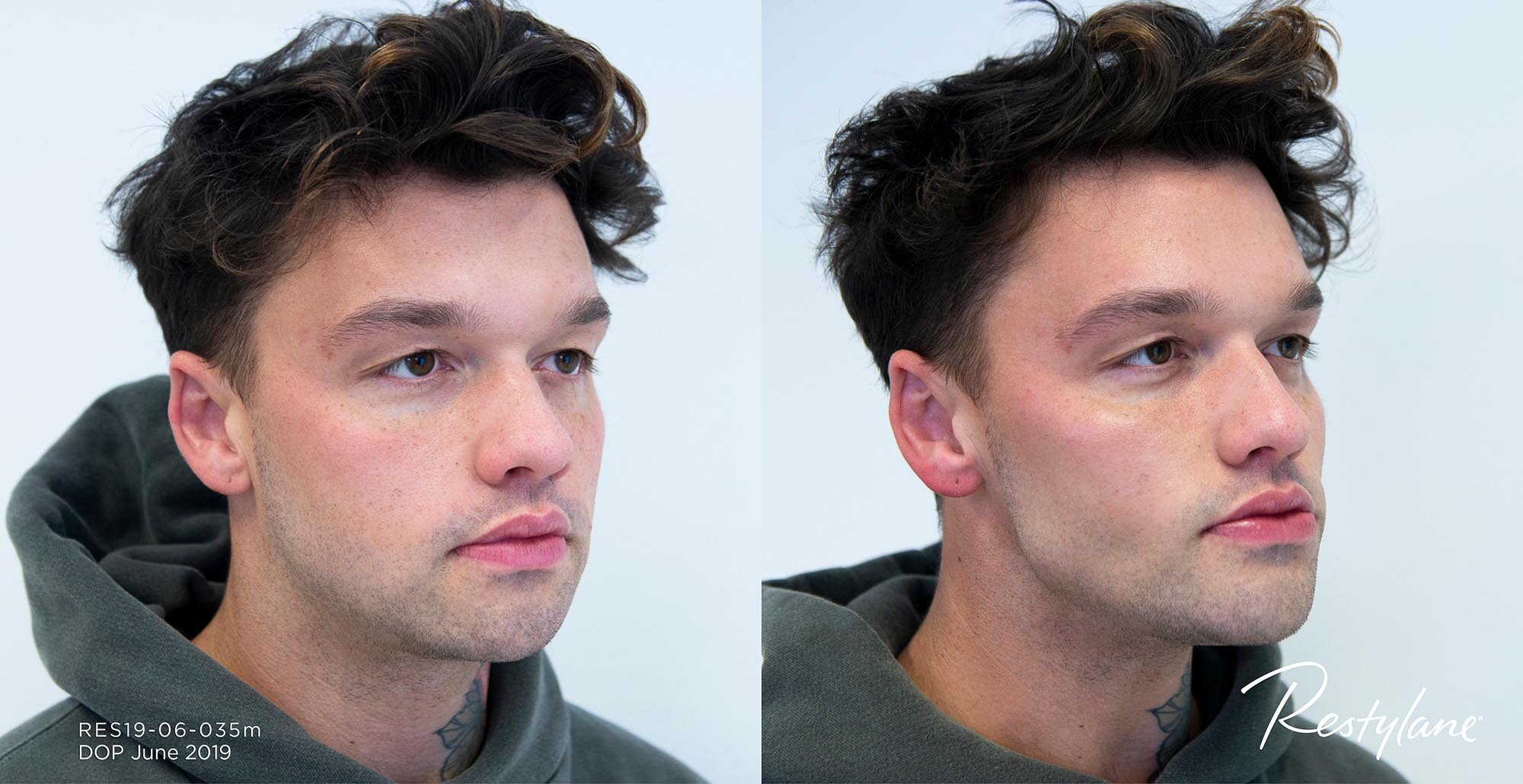 Fillers can shorten midface | Looksmax.org - Men's Self-Improvement ...