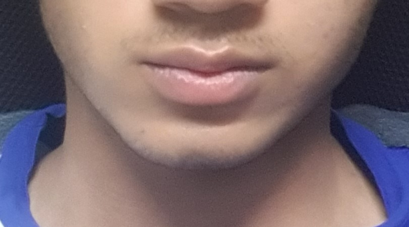 Is it possible to fix short chin and how badly does it affect looks in ...