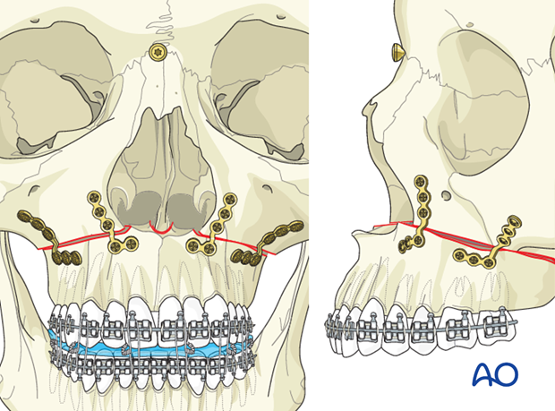 Basic Jaw and Midface Osteotomy Guide | Looksmax.org - Men's Self ...
