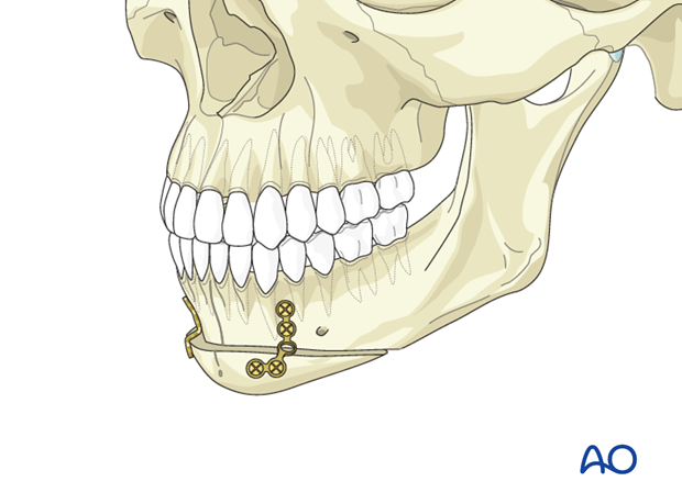 Basic Jaw and Midface Osteotomy Guide | Looksmax.org - Men's Self ...