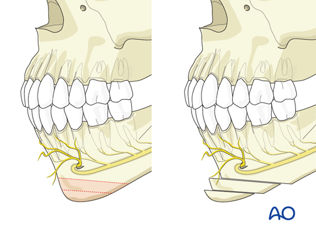 Basic Jaw and Midface Osteotomy Guide | Looksmax.org - Men's Self ...