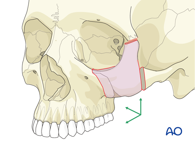 Basic Jaw and Midface Osteotomy Guide | Looksmax.org - Men's Self ...