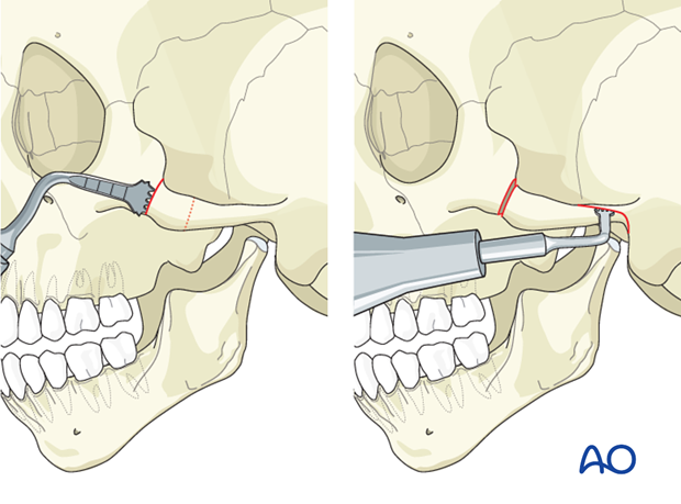 Basic Jaw and Midface Osteotomy Guide | Looksmax.org - Men's Self ...