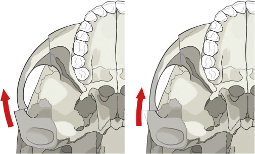 Basic Jaw and Midface Osteotomy Guide | Looksmax.org - Men's Self ...