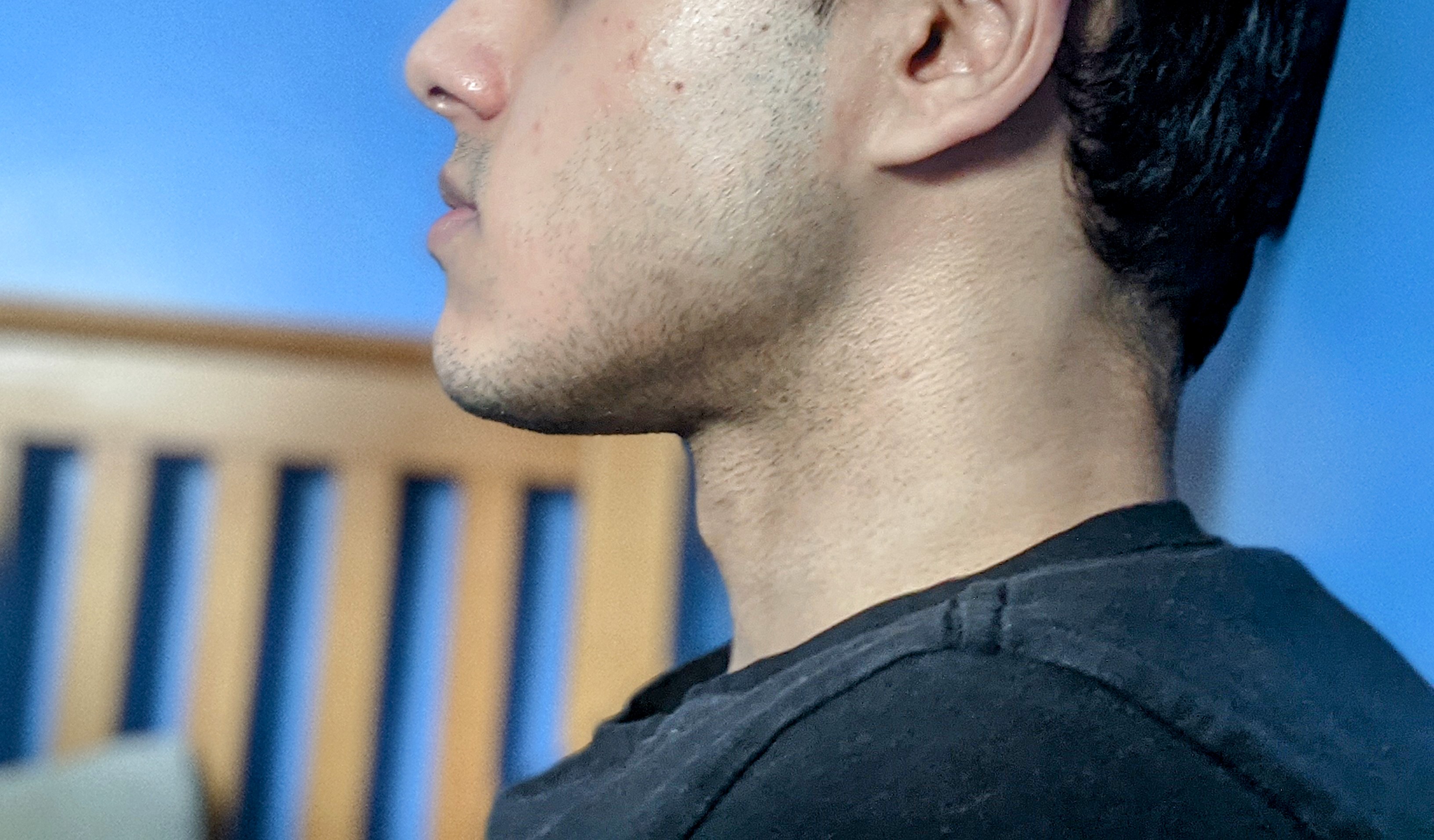 Will Invisalign fix my recessed maxilla + change my jaw? | Looksmax ...