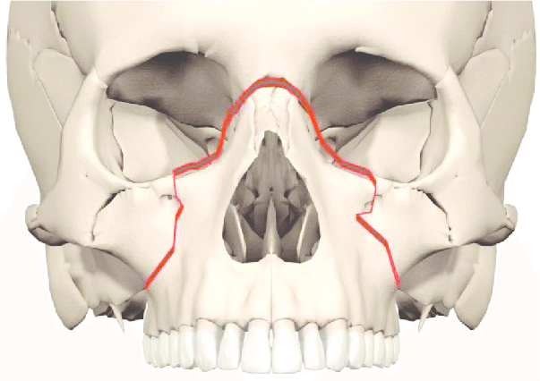 Yesterday while thumbpulling I felt and heard cracking in whole lefort ...