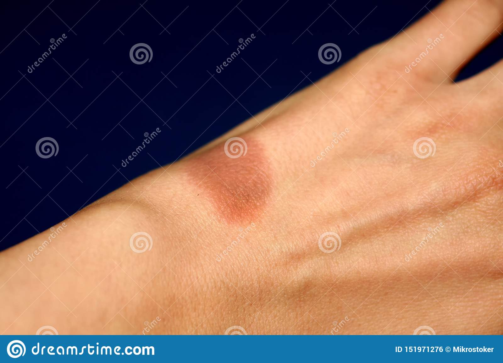 How to remove a burn mark | Looksmax.org - Men's Self-Improvement ...
