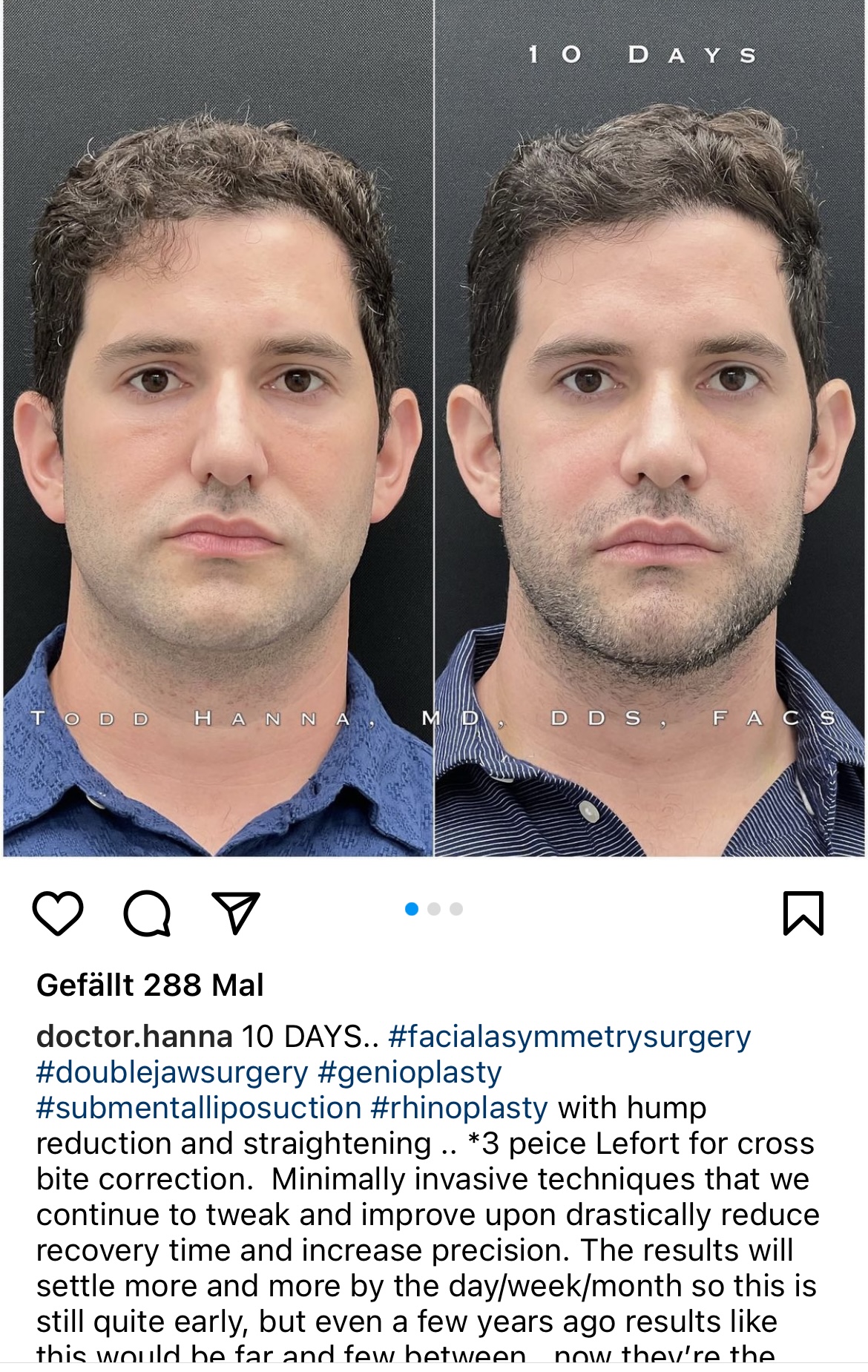 Guy looks the same after bimax+genio | Looksmax.org - Men's Self ...