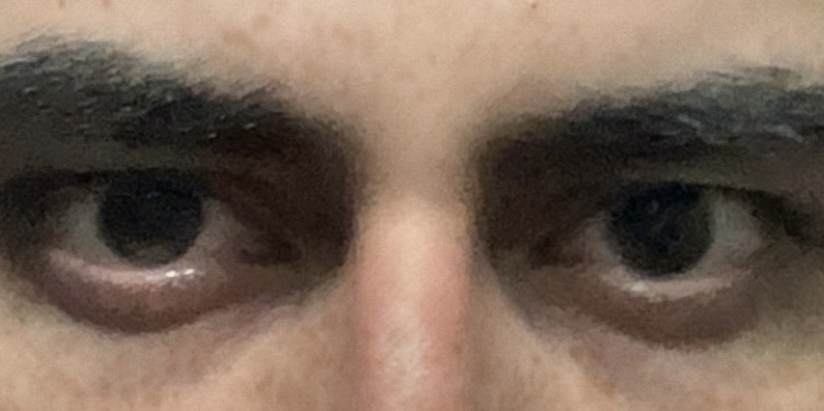 Does losing fat mean less eye hooding? | Looksmax - Men's Self ...