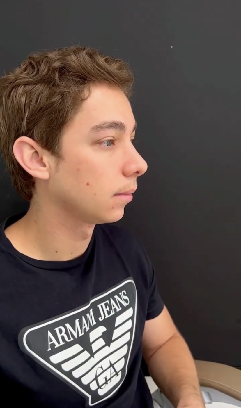 Rate this chin implant transformation | Looksmax.org - Men's Self ...