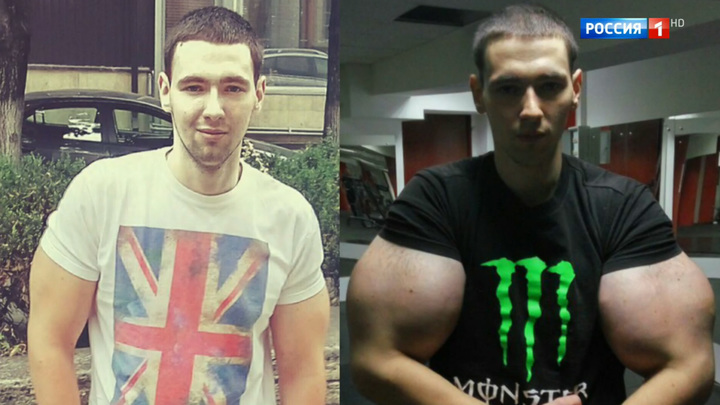 Huge looksmax from fillers and body maxing. | Looksmax - Men's Self ...