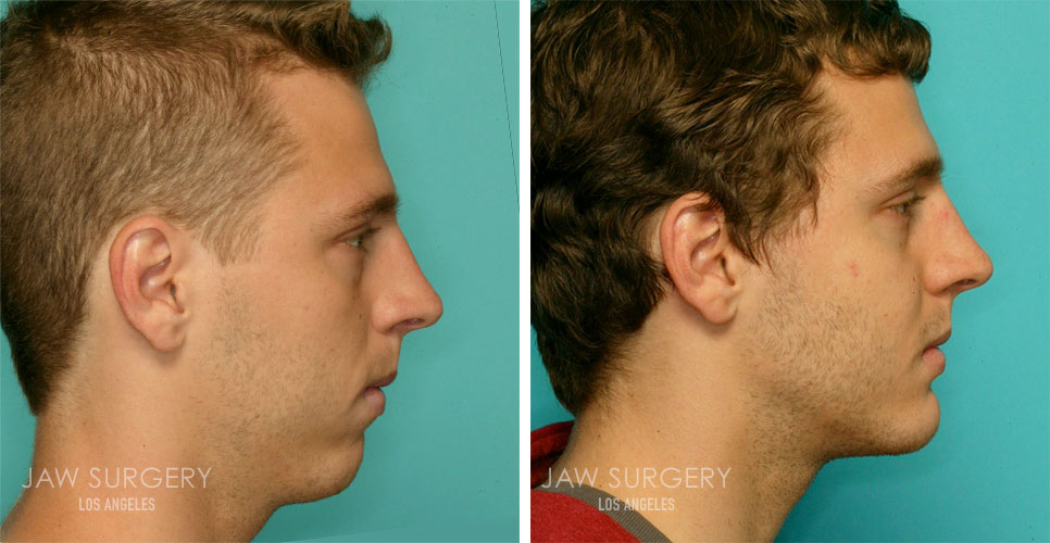 Examples of bimax on normie/very slightly recessed chins? | Looksmax ...