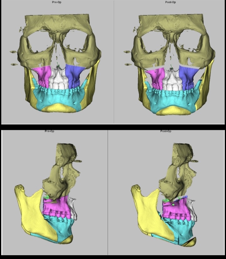 How do I fix my jaw asymmetry | Looksmax.org - Men's Self-Improvement ...