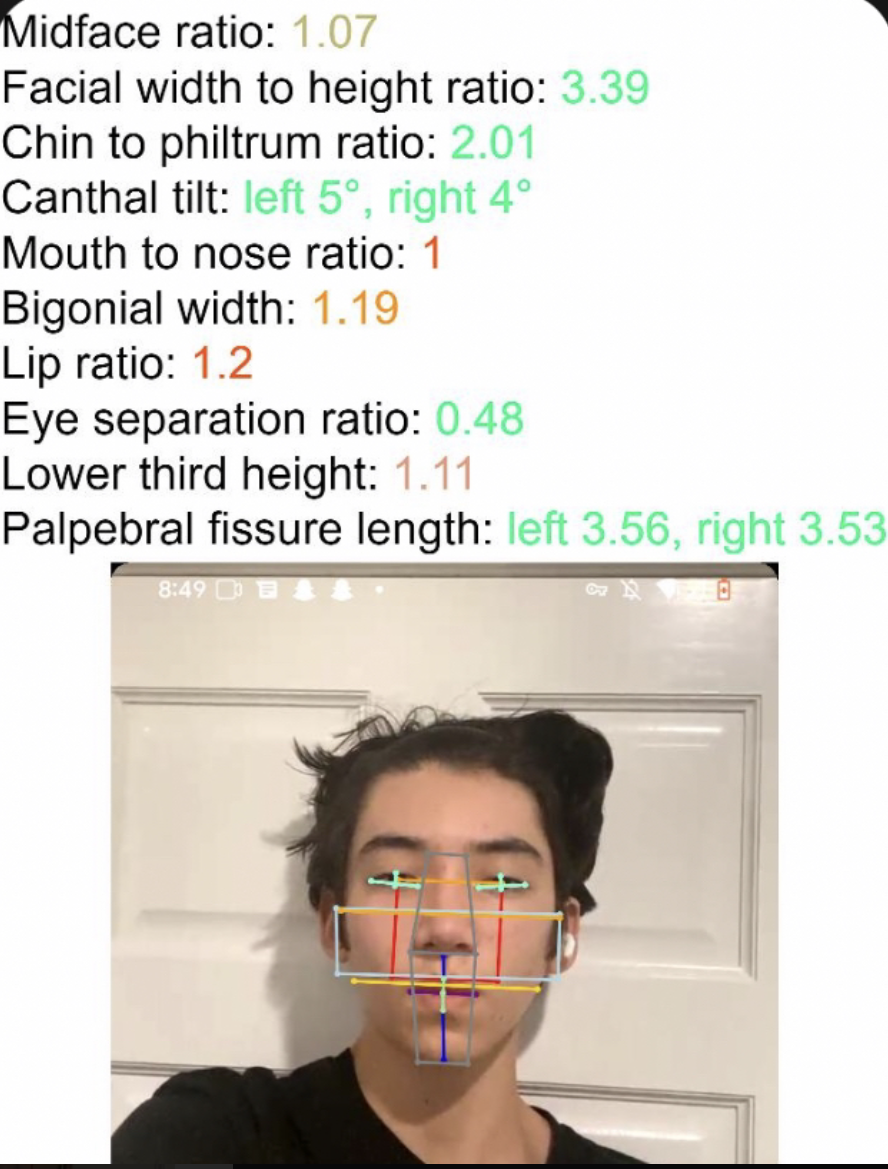 Is it over for my midface ratio | Looksmax.org - Men's Self-Improvement ...