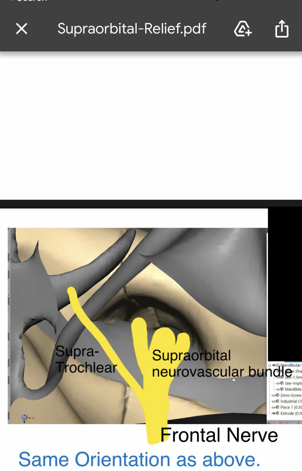 If you have short eyebrows length you have a supra orbital notch ...