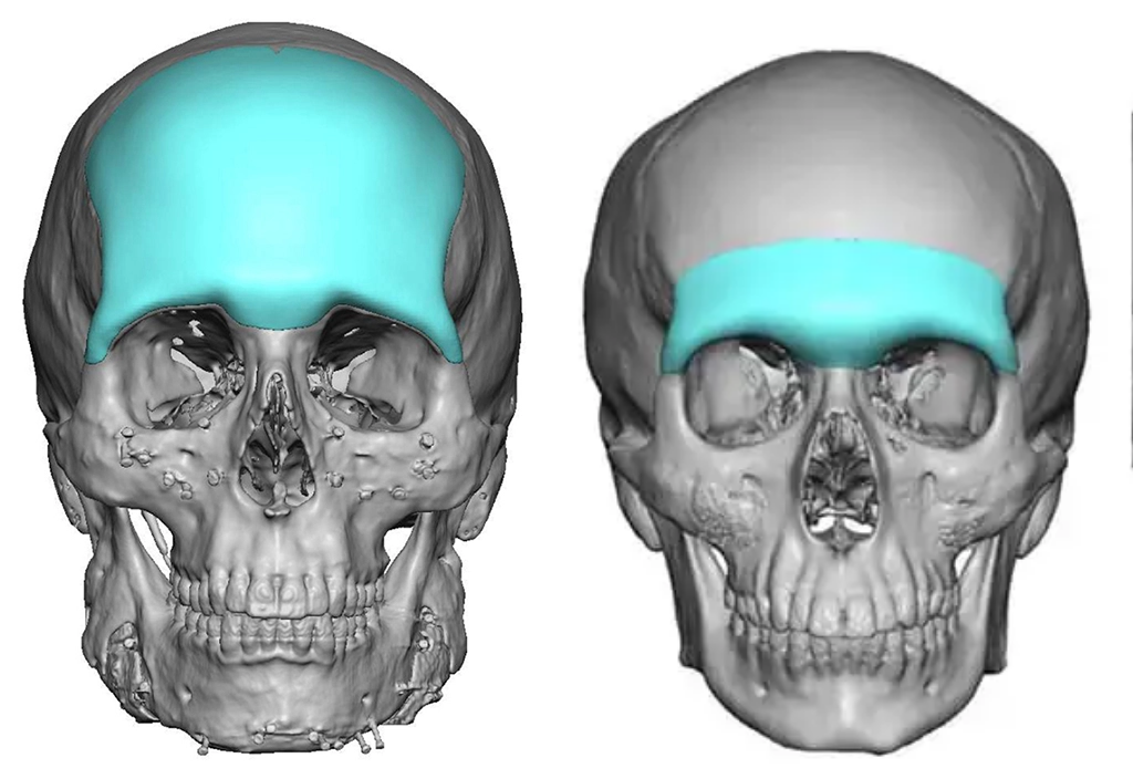 Monobloc vs Eppley's skull implants vs Forehead remodelling for ...
