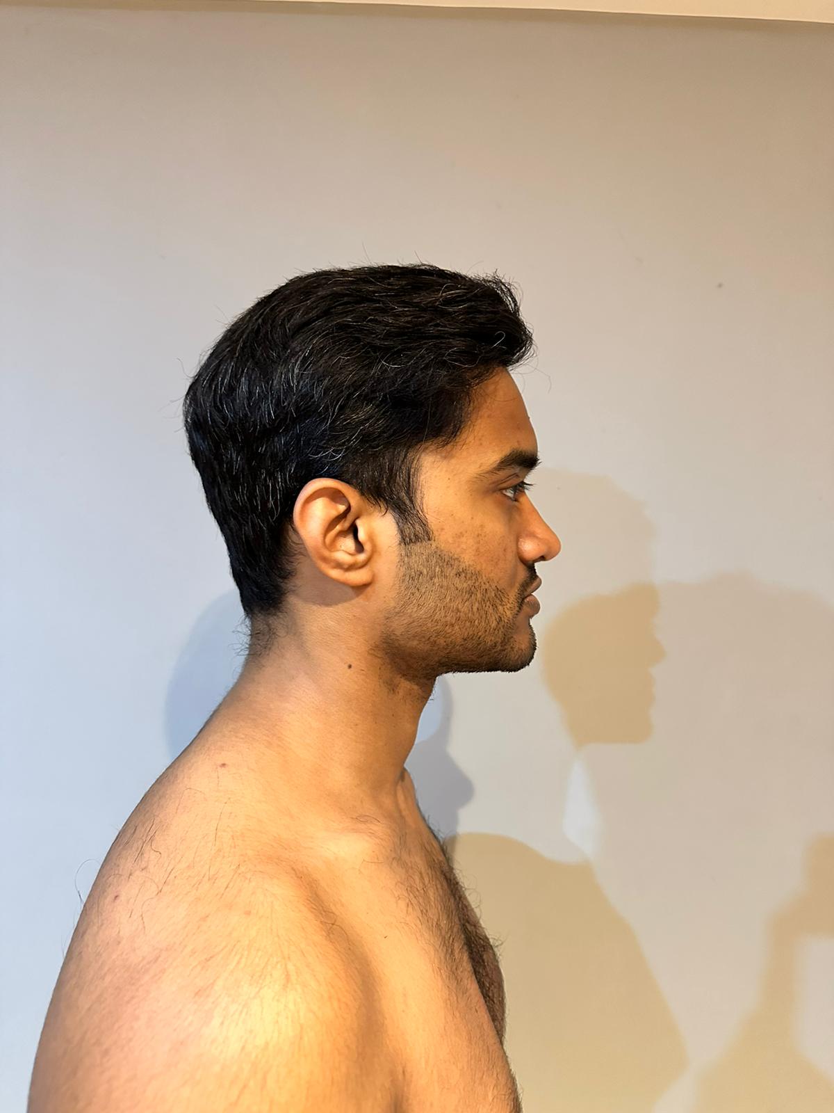 Thoughts on my Implant design includes supra, infra and jaw angles ...