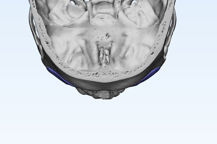 Thoughts on my Implant design includes supra, infra and jaw angles ...