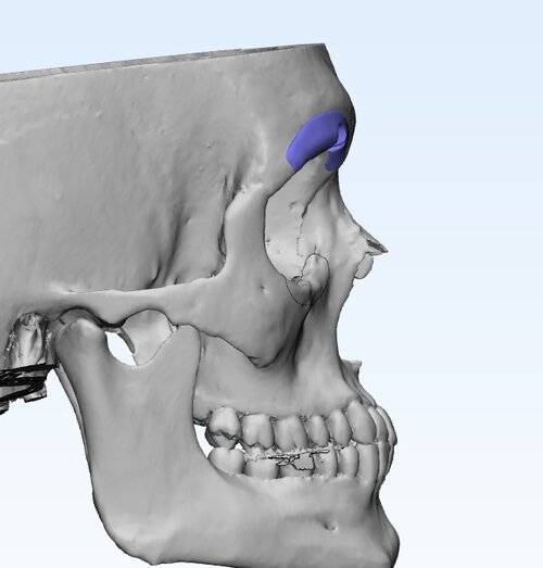 Thoughts on my Implant design includes supra, infra and jaw angles ...
