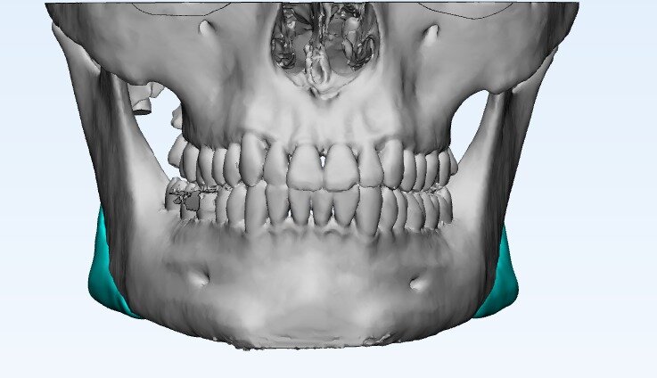 Thoughts on my Implant design includes supra, infra and jaw angles ...