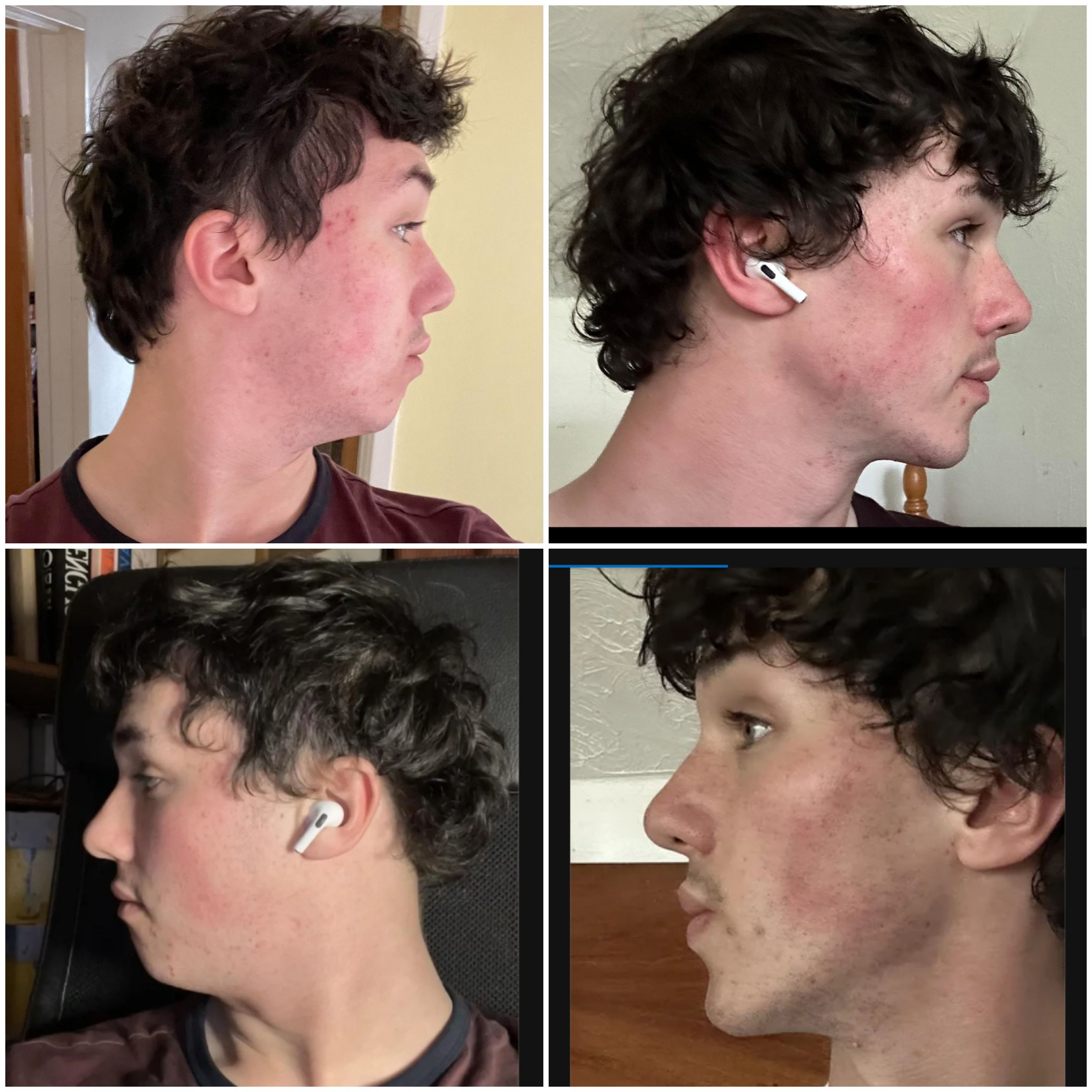 Man becomes chad in 5 months thanks to mewing | Looksmax.org - Men's ...