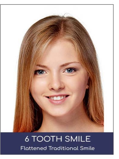 Your palatal expansion gains from mewing are limited by the size of ...