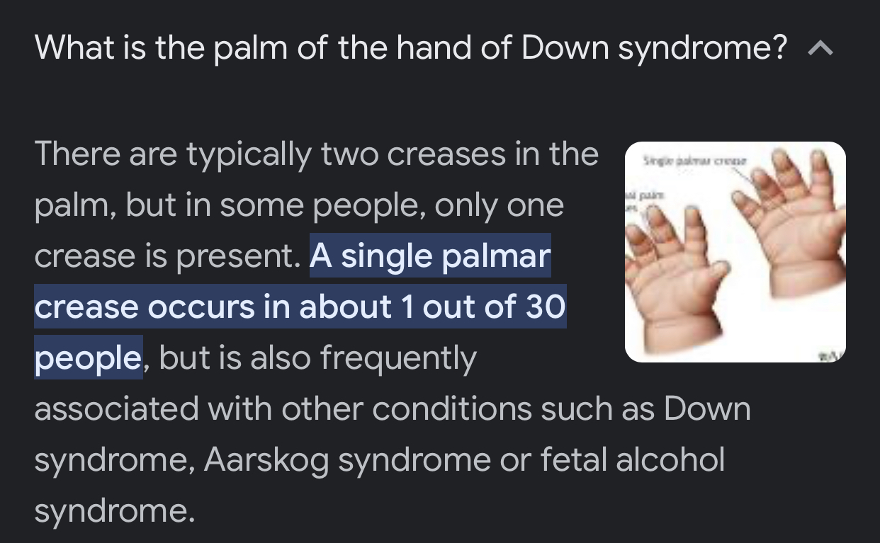 Rate my hands. Do I need finger lengthening surgery? Is it over ...