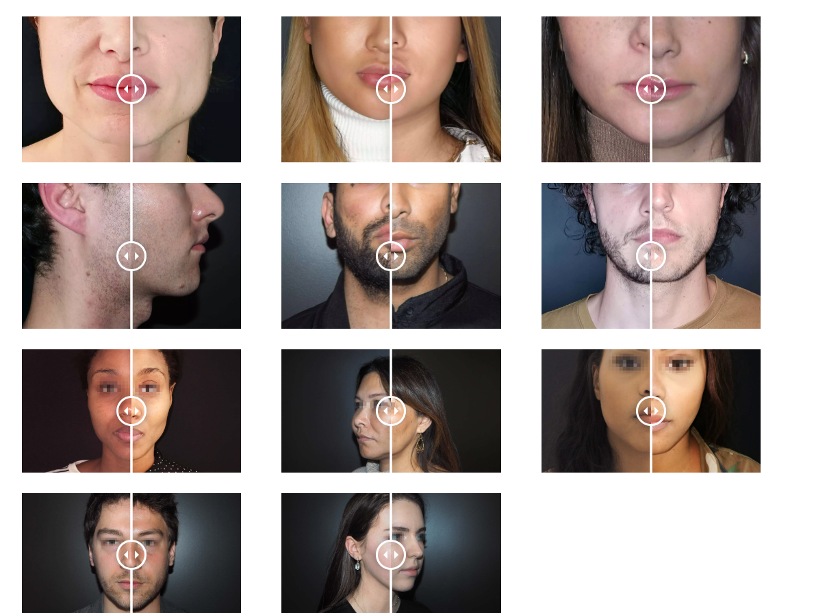Buccal fat removal is an absolute scam | Looksmax.org - Men's Self ...