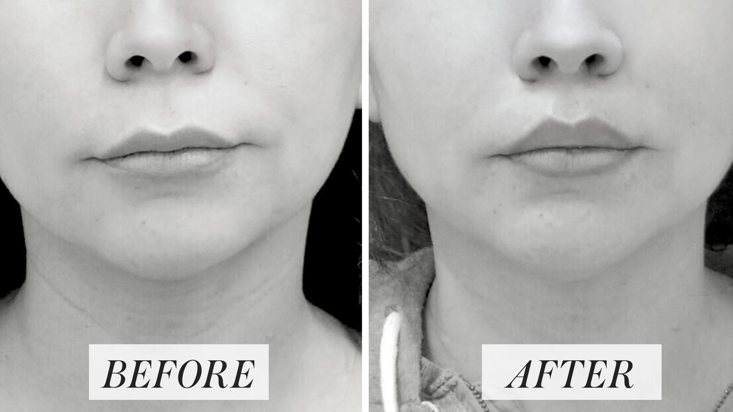 Why cant long midface be fixed with surgery? | Looksmax.org - Men's ...