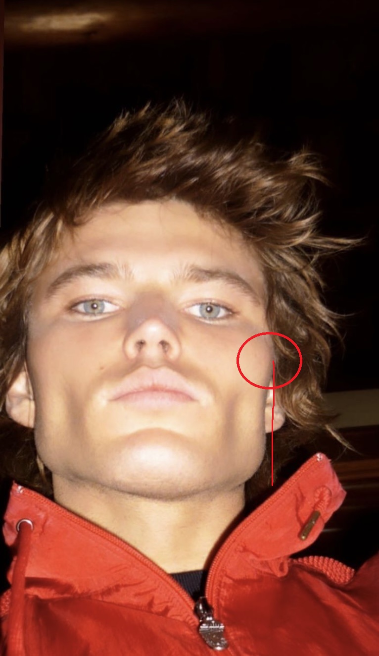 alessandro dellisola has no zygo lateral projection | Looksmax.org ...