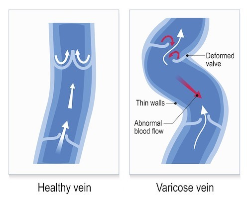Being "vascular" means you are UNHEALTHY and shaving years off your ...