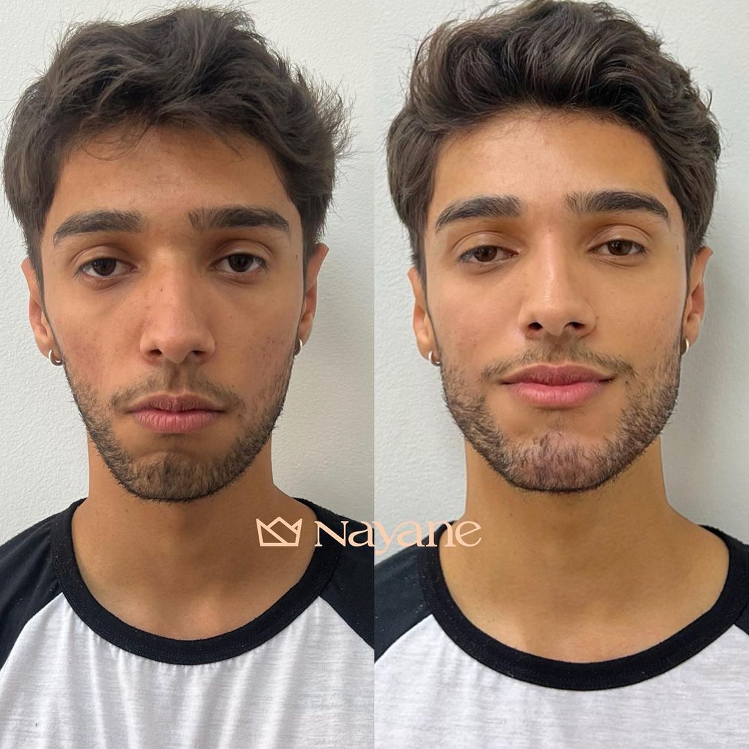 Jaw filler results | Looksmax - Men's Self-Improvement & Aesthetics