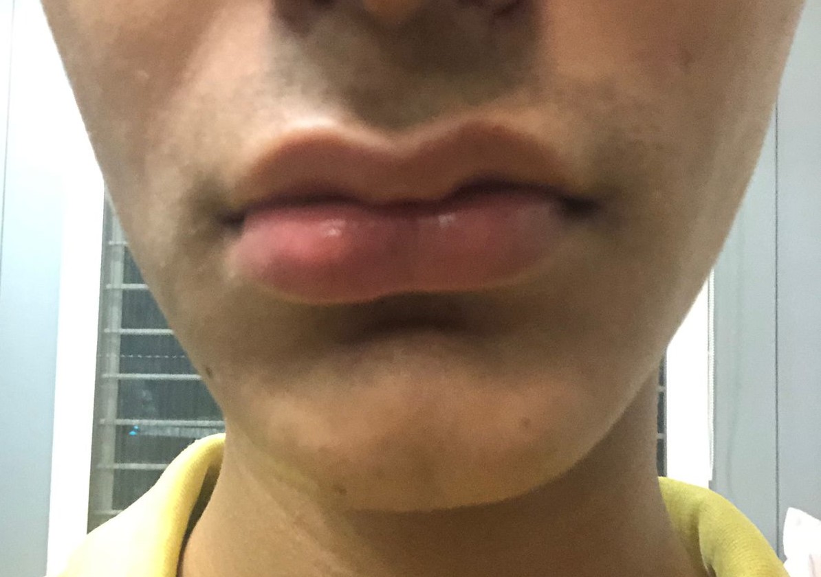 very noticeable asymmetry, especially in jaws and lips. why does this ...